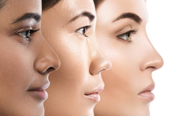 Skin Types according to The Fitzpatrick Scale - SUNSPA